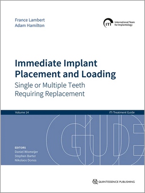 Immediate Implant Placement and Loading ( ITI Treatment Guide, Volume 14) - Online Dental Library
